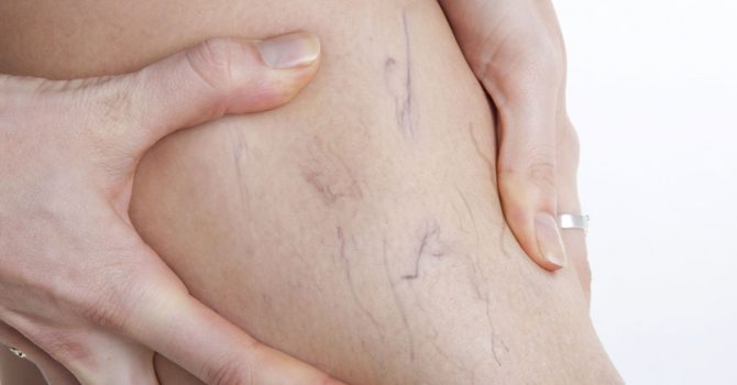 Varis Nedir, Neden Olur ve Tedavisi – Lorem